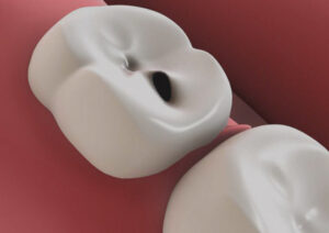 Hole in Tooth Treatment Stamford| Best Quality Cavity Fillings in CT