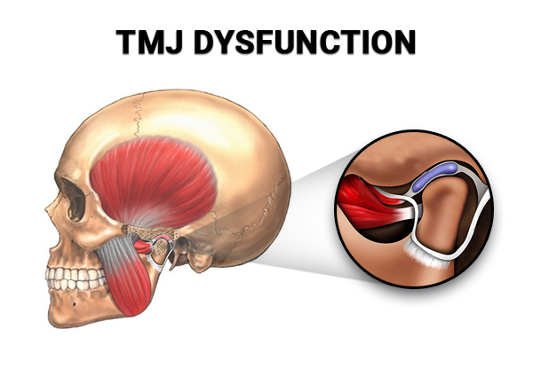 Treating TMJ With Trigger Point Dry Needling Physical, 58% OFF